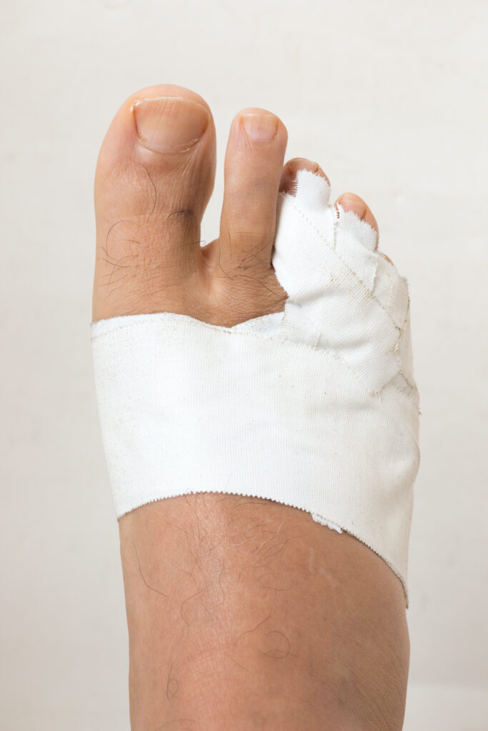 Common Summer Toe Injuries | Kansas City Foot Specialists